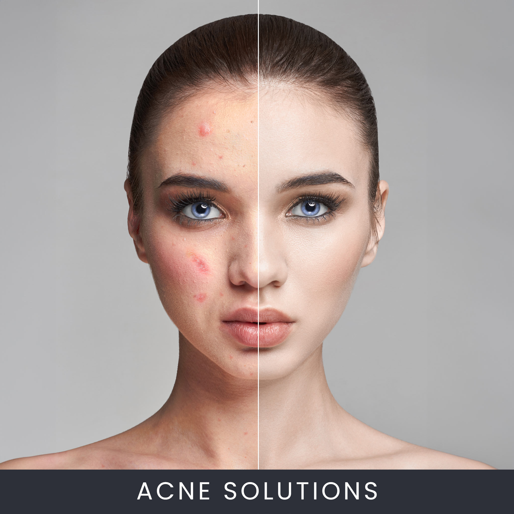 Acne Solutions Facial Course - The Online Beauty Courses IRELAND