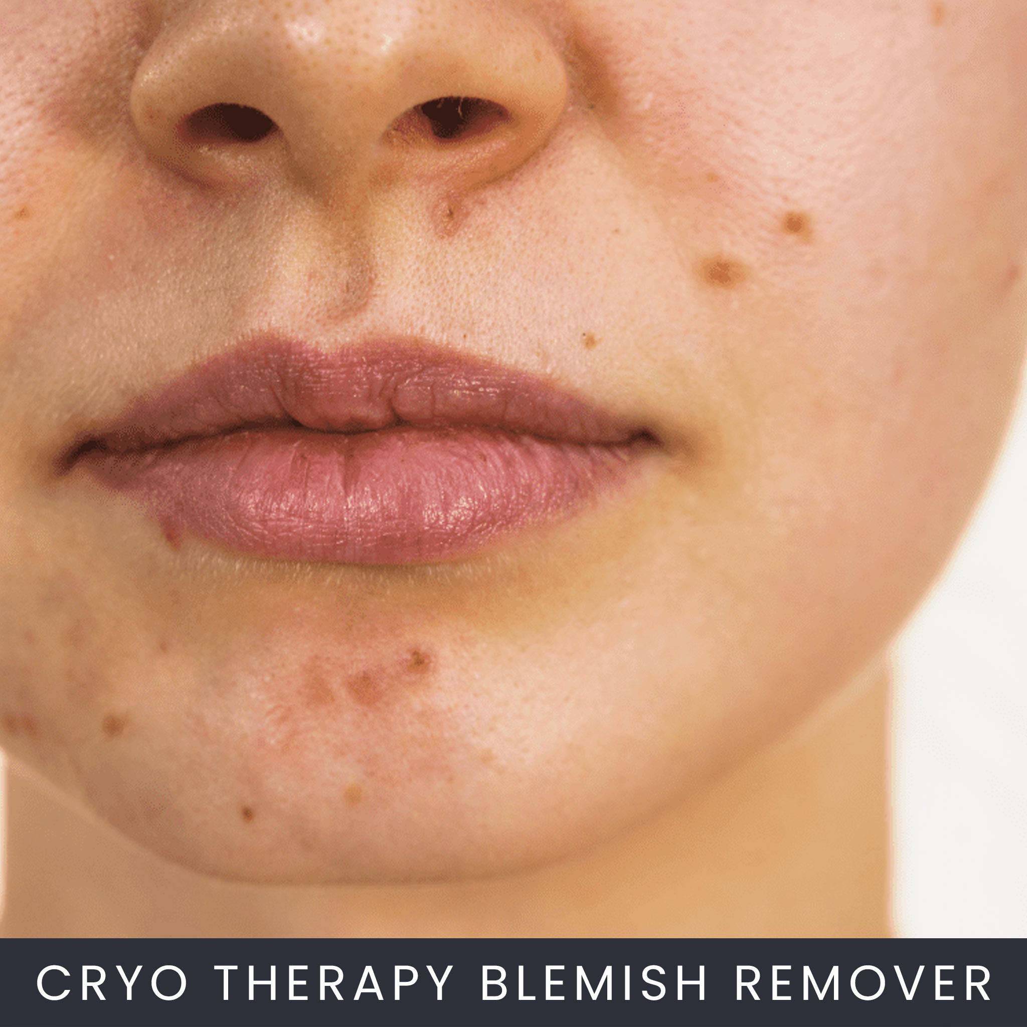 Online Cryo Therapy Blemish Remover Course - The Online Beauty Courses ...