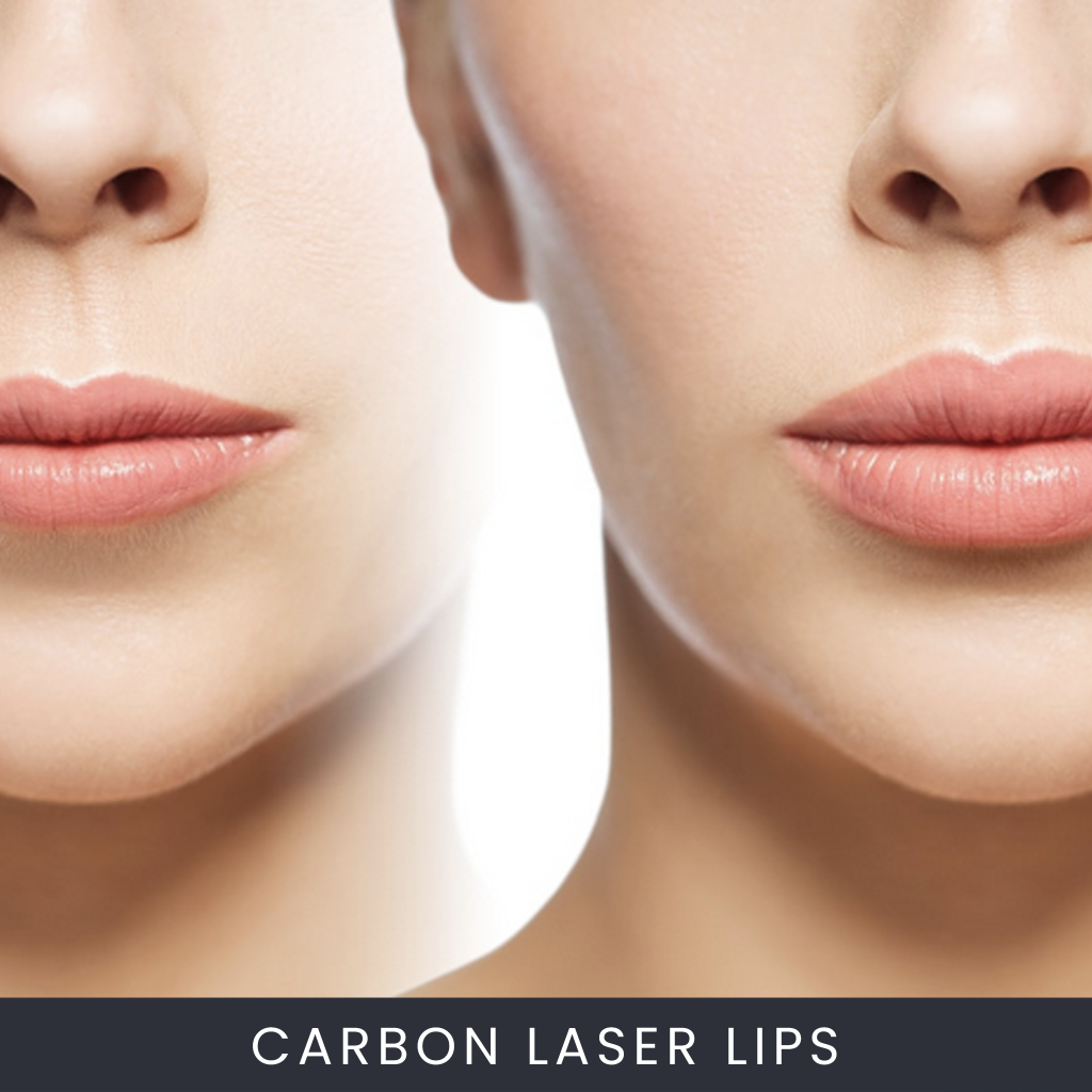 Online Carbon Laser Lip Plumping Course - The Online Beauty Courses ...